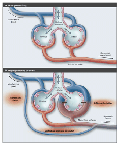 Medicine Decoded: Platypnea-orthodeoxia